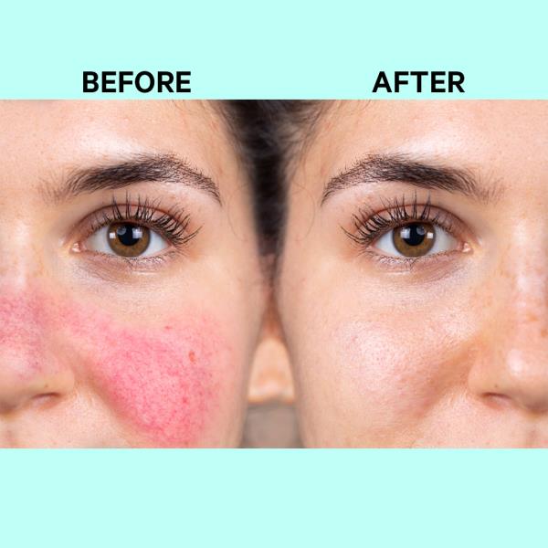 Flushing & Vascular, Laser, Aesthetic Laser and Skin Clinic